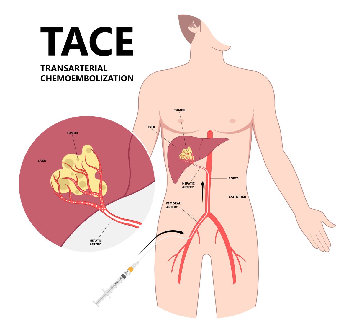 Cancer care services in Geelong | Holistic Imaging
